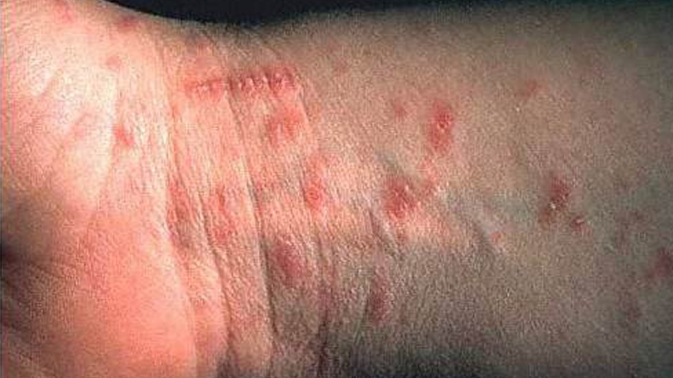 Skabb ökar i Västerbotten – överläkaren uppmanar att söka vård