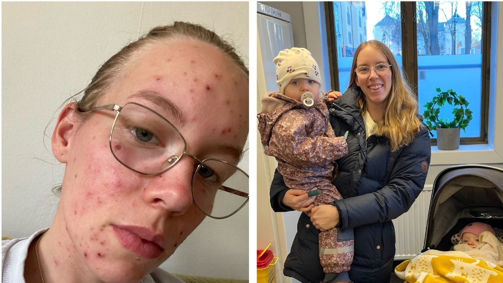 Vattkopporna blev en mardröm för tvåbarnsmamman Josefin, 27